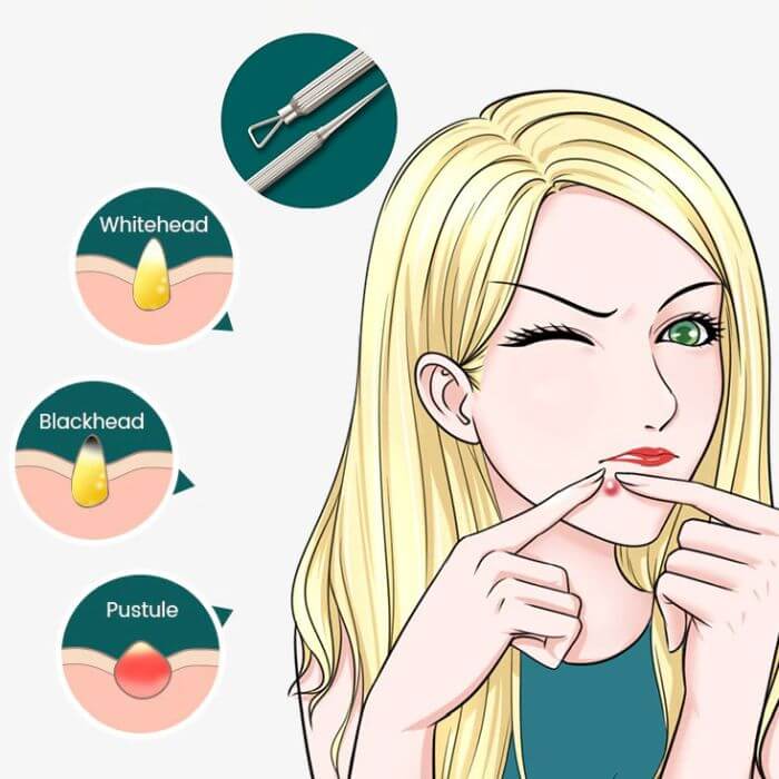 Professional acne extraction tool Mr. Pimple